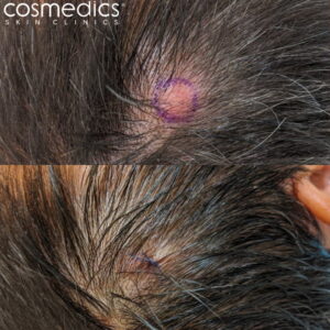 Cyst Removal London Surgical Treatment | Cosmedics Skin Clinics