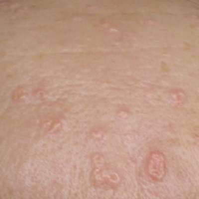 Sebaceous Hyperplasia Removal | Cosmedics Skin Clinics