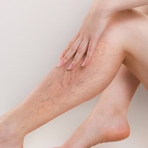Thread Vein & Spider Vein Removal | Cosmedics Skin Clinics
