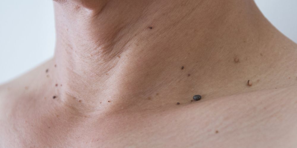 Skin Tags on Body: Info & Causes | Cosmedics Skin Clinics