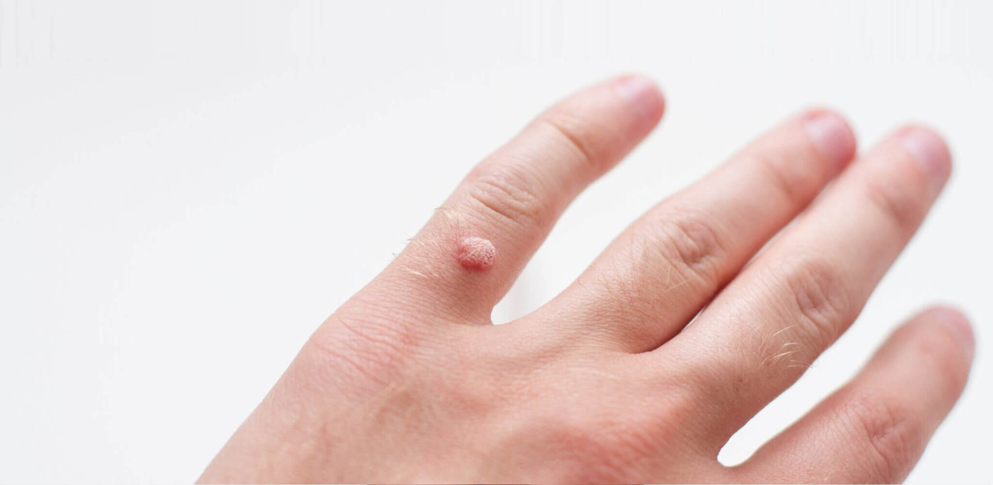 Wart Removal London and Bristol | Cosmedics Skin Clinics