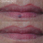 Laser Venous Lake Treatment; Lip Blood Blister | Cosmedics Skin Clinics