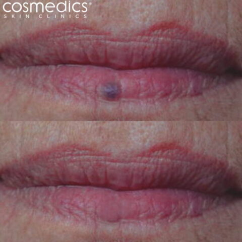 Laser Venous Lake Treatment; Lip Blood Blister | Cosmedics Skin Clinics
