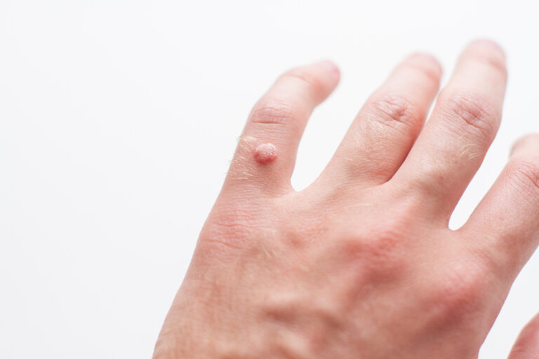 Different Types of Warts: What Kind of Warts Are Contagious?