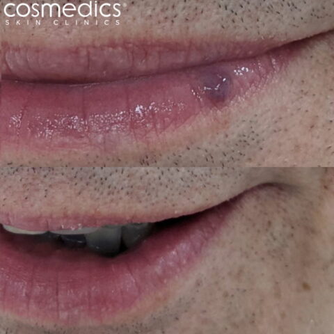 Laser Venous Lake Treatment; Lip Blood Blister | Cosmedics Skin Clinics
