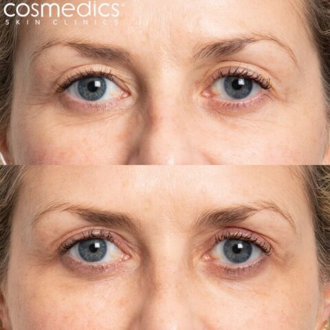 Upper Bleph Eyelid Lift Treatment Video and Photos | Cosmedics