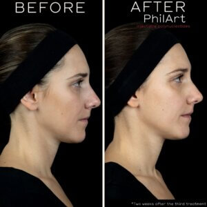 PhilArt® Polynucleotides Regeneration | Cosmedics Skin Clinics