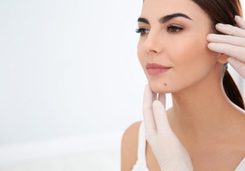 Shave Excision Mole Removal | Cosmedics Skin Clinics